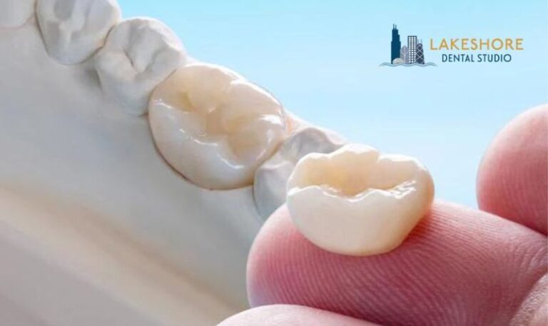 What to Do When Your Dental Crowns Break: A Guide