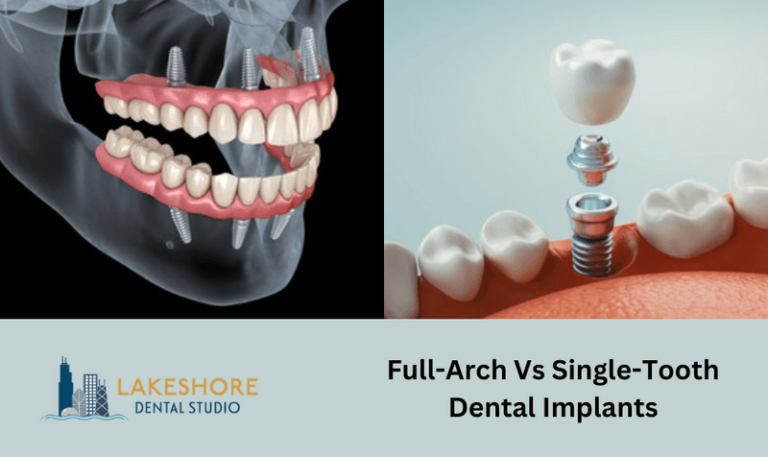 Full-Arch Dental Implants: A Comprehensive Guide